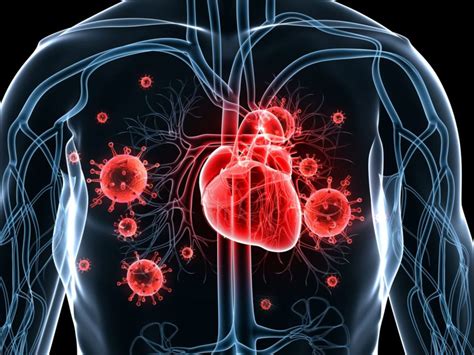Endocarditis Prophylaxis Penicillin Allergy At Sam Hamby Blog