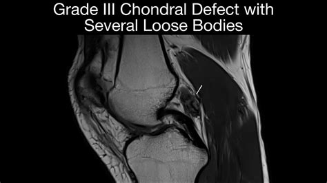 Grade Iii Chondral Defect With Several Loose Bodies Youtube