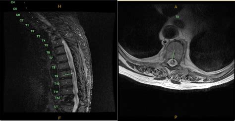 Mri Demonstrating Cavernous Malformation In Short Tau Inversion