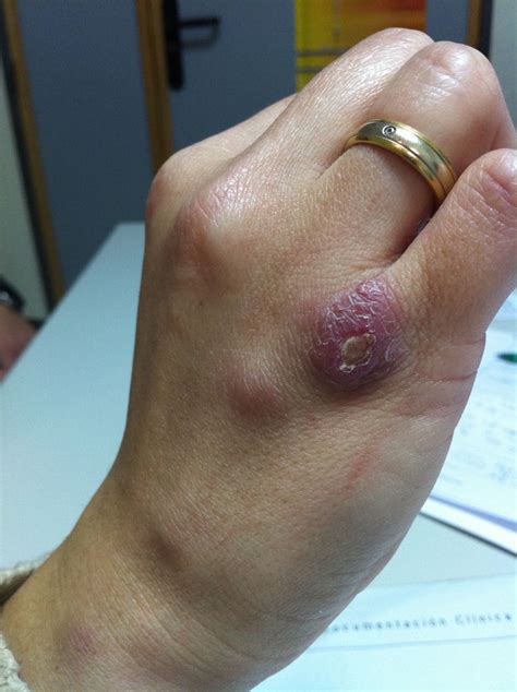 Ulcerated Lesion On The Right Hand With A Torpid Course And Subsequent
