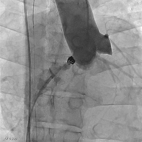 Figure 2 From Pediatric And Congenital Heart Disease Case Report