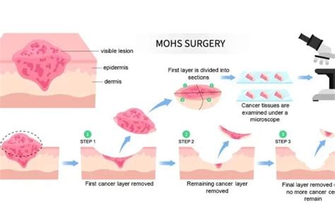 mohs surgery archives dermatology and mohs surgery skin cancer center