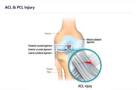 Non Surgical Treatment For Acl Pcl Tear Solana Beach Ca