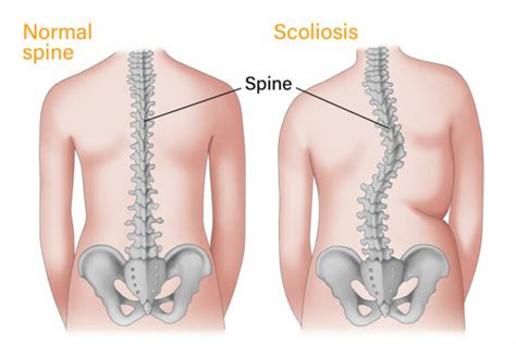 Adult Scoliosis Treatment Know Your Options Square One