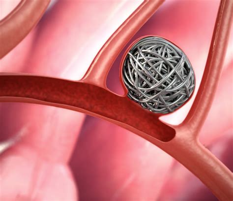 Neuro Embolization Procedure Penumbra Inc