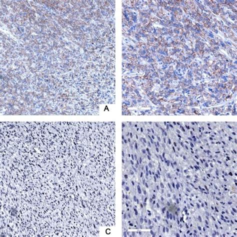 Typical Immunohistochemical Staining Of Pd L1 In Retroperitoneal Download Scientific Diagram