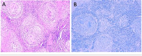 A Lymph Node Architecture Was Replaced By Wellcircumscribed