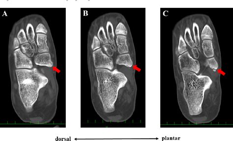 Figure 1 From Is The Small Ossicle Of Type 1 Accessory Navicular A