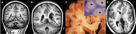 Malformations Of Cortical Development Burdens And Insights From