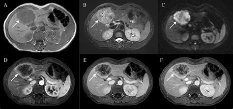 Frontiers Preoperative Differentiation Of Hepatocellular Carcinoma With Peripheral Rim Like