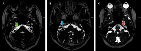 Prevalence Of Vascular Loops Of The Anteroinferior Cerebellar Artery