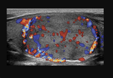 Photo Gallery What Do Thyroid Nodules Look Like On Imaging