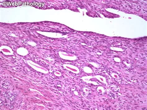 Mesonephric Duct Remnants