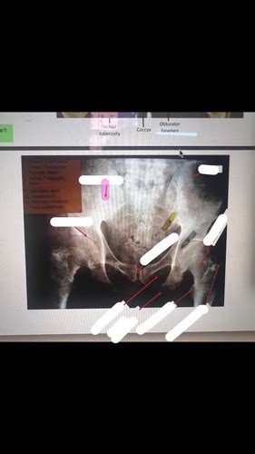 X Ray Diagrams Flashcards Quizlet