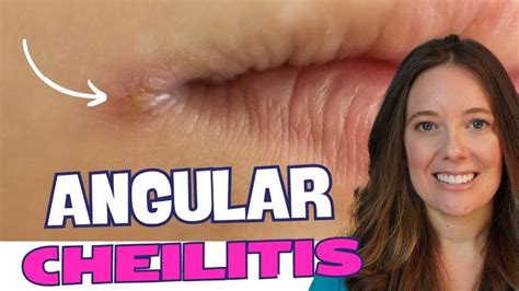 Overnight Angular Cheilitis Treatment