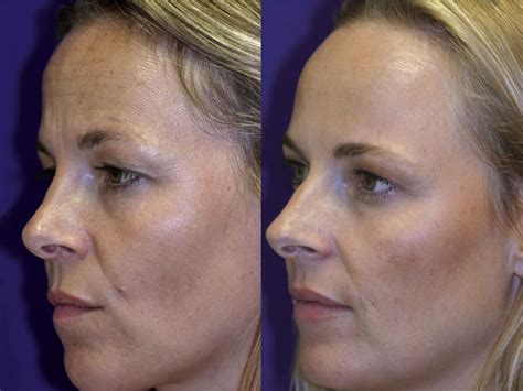 Botox Effects What Happened When Only One Twin Got Treated Faculty