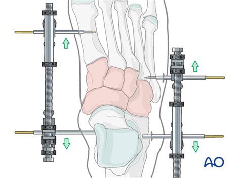 Lag Screw Fixation For Complete Articular Navicular Fracture