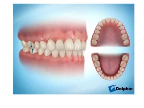 Classification Of Occlusion And Malocclusion Dr Nabil Al Zubair