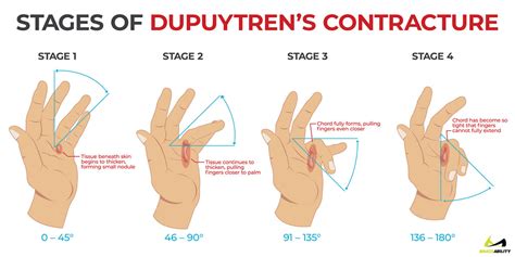 Dupuytrens Contracture Do Your Fingers Cramp Curve Or Curl Up