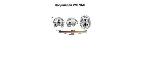 Brain Regions Showing Consistent Increased Activation In The Left