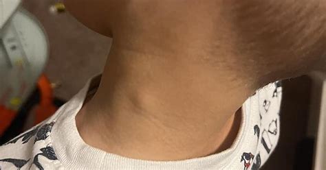 Lymphnodes Album On Imgur