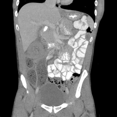 Pdf Insidious Presentation Of Intussusception With Appendicitis