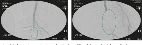 Figure 1 From Angio Seal™ Embolization A Rare Etiology Of An Acute