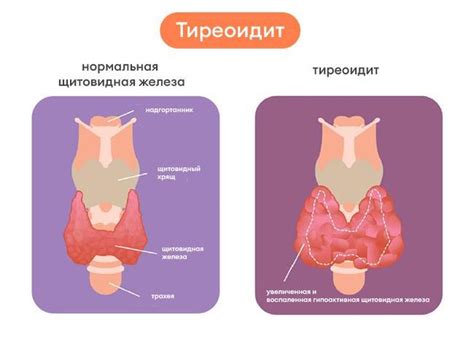 Тиреоидит описание симптомы диагностика и лечение ЛабСтори