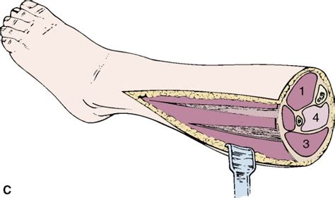 骨科筆記 Fasciotomy