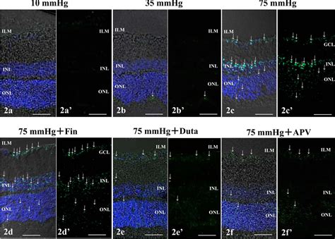 Axonal Swelling Semantic Scholar