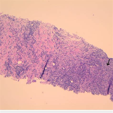 Inflamed Tissue Black Arrow With Pink Areas Of Storiform Fibrosis Download Scientific Diagram