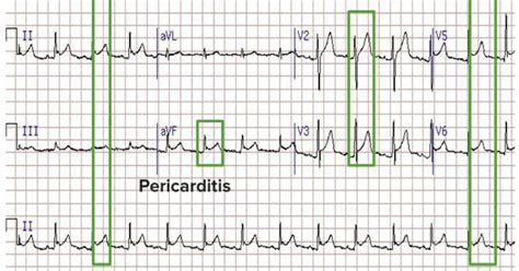 12 Lead Ecg Placement Step By Step Guide Lecturio Medical