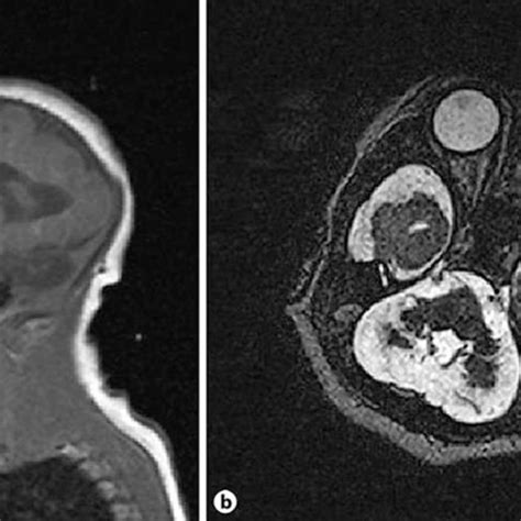 Computed Tomography Scan Showing Subcortical Diffuse Periventricular Download Scientific
