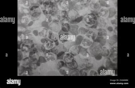 1960s Microscopic View Of Irradiated Bone Marrow Compared With Healthy