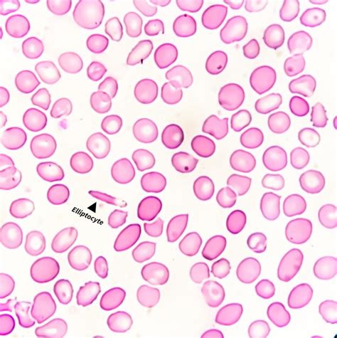 Visión Microscópica De Una Diapositiva Hematológica Que Muestra