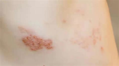 缠腰龙如刀割般令人疼痛难忍，竟是癌症前兆，是真相还是谣言吗？ 知乎
