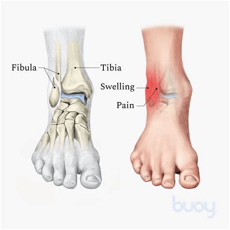 Ortho Globe Understanding Ankle Fractures