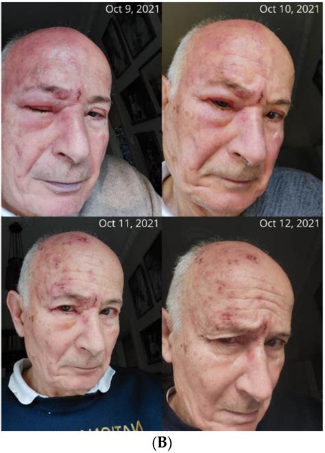 Dermatomes Face Shingles