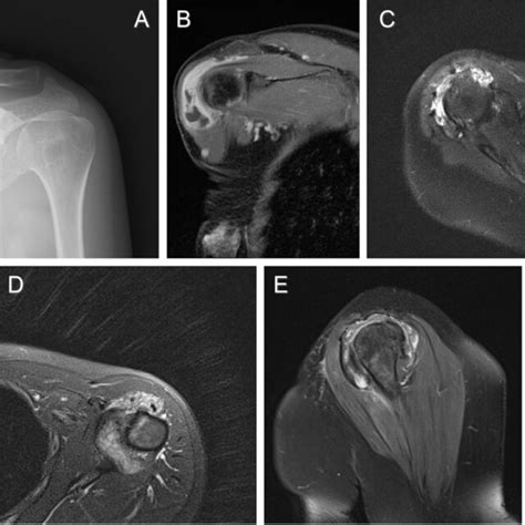 Radiological Manifestations Of Shoulder Pvns A Plain Film Shows Low Download Scientific
