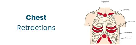 Causes And Treatment For Chest Retractions