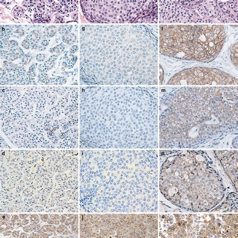 Pdf E Cadherin Alterations In Atypical Lobular Hyperplasia And