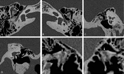 Ct Scan Showing Ossicular Chain Arthritis Associated With Os