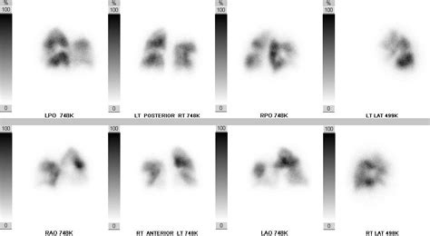 CTEPH Radiology Case Study In CTEPH