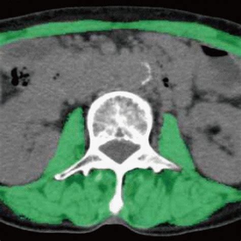 Representative Of Ct Scan Image After Skeletal Muscle Area Was Download Scientific Diagram