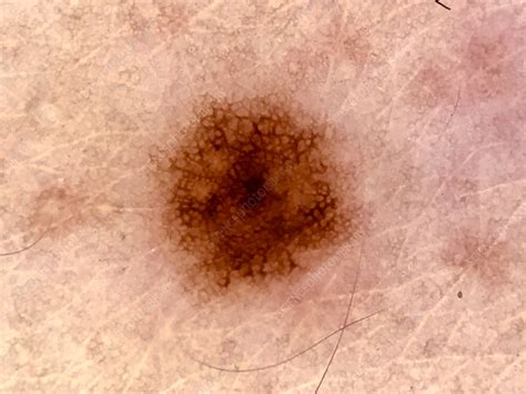 Reticular Naevus Dermoscopy Stock Image C056 2571 Science Photo