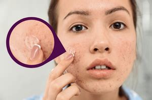 Is It OK To Use Pimple Patches Appalachian Spring Dermatology