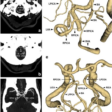 Bilateral Duplicated Hypoplastic Superior Cerebellar Arteries One Of Which Originates From A