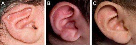 Identification Of Newborn Congenital Ear Deformities Allows For Timely
