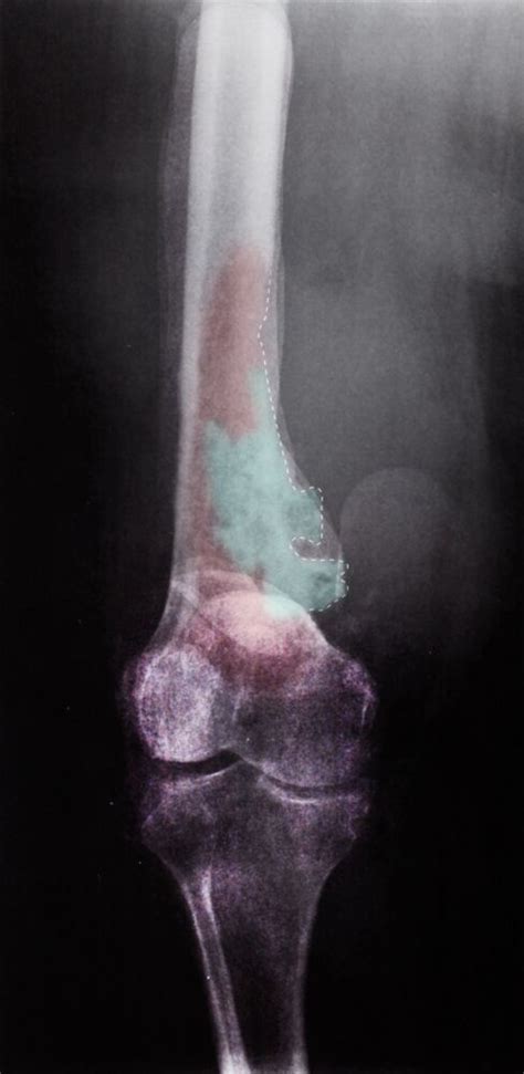 Fibrosarcoma X Ray