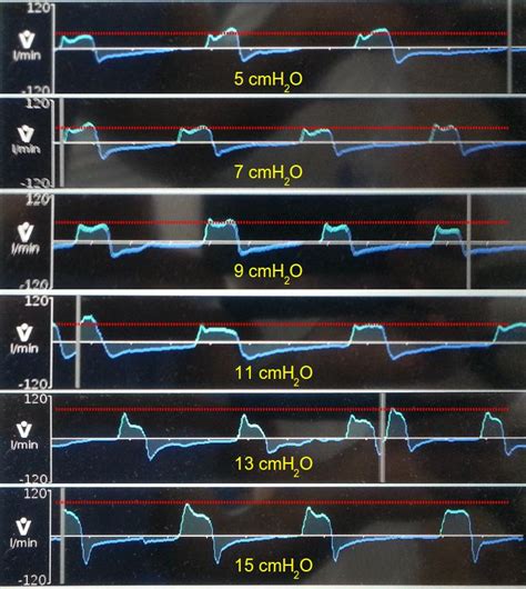Ipapとは Epap 人工呼吸器 Pkle